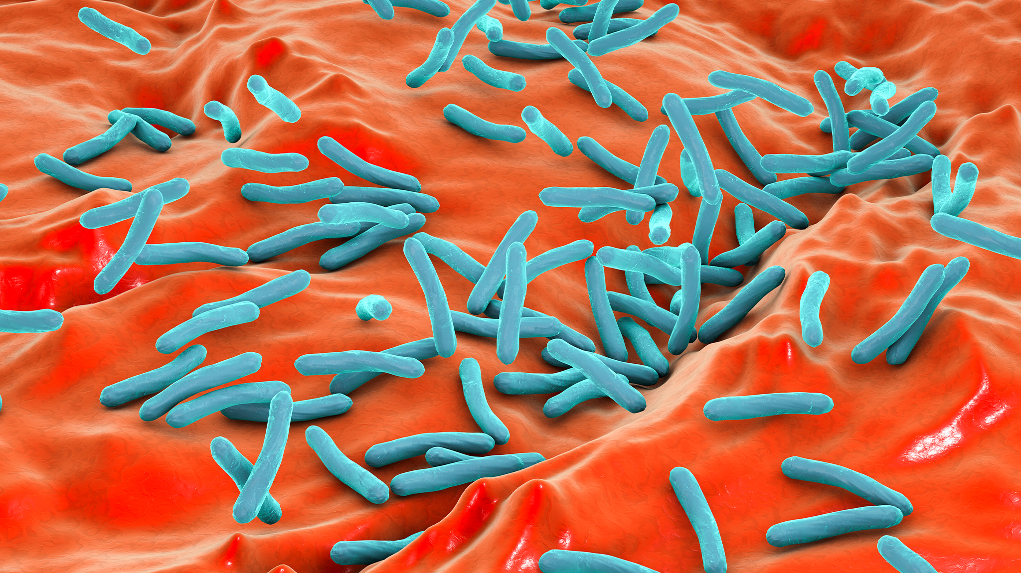 Tackling TB - Crohn's Colitis Professional