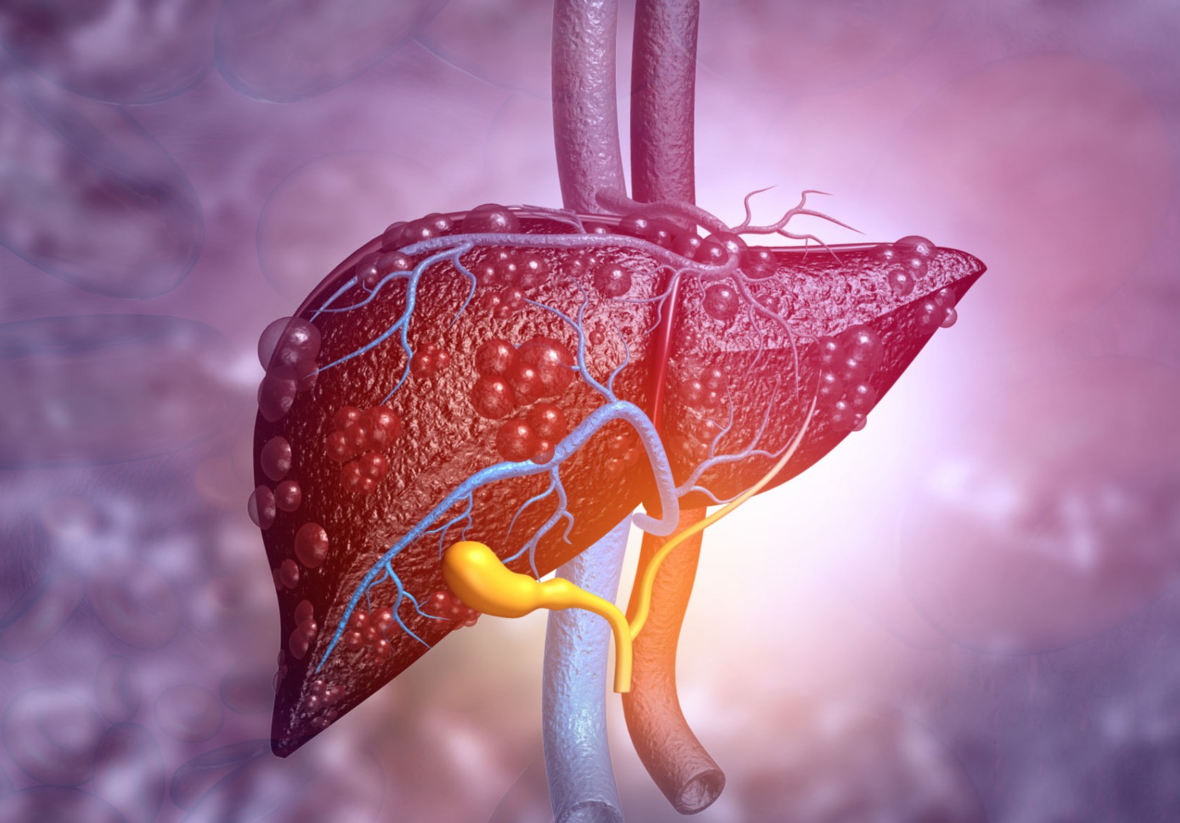 FDA Approves Madrigal Pharmaceuticals Drug as First Treatment for ...