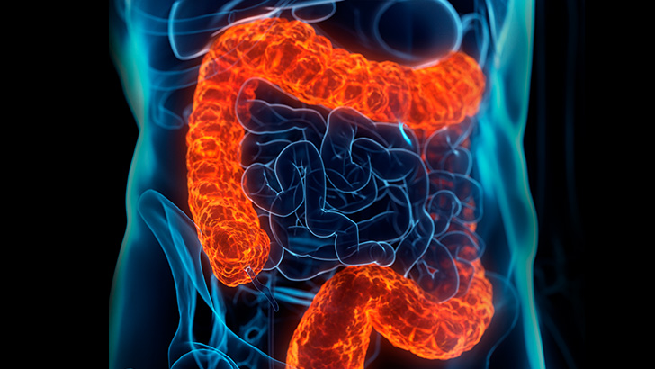 Is It Pouchitis or Crohn’s Disease of the Pouch? - Crohn's Colitis ...